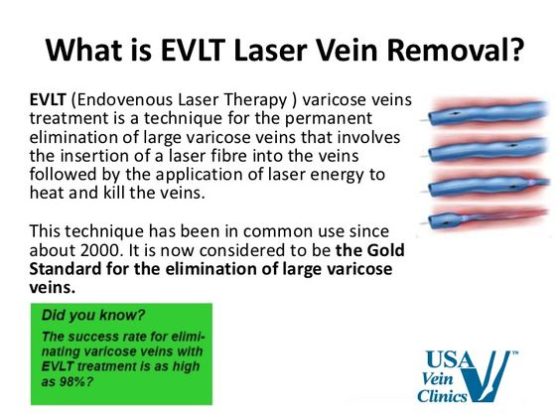 Long-term Efficacy of EVLT Varicose Vein Treatment