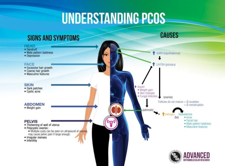 Top 5 Easy Ways To Get-rid of PCOD Without Medicine