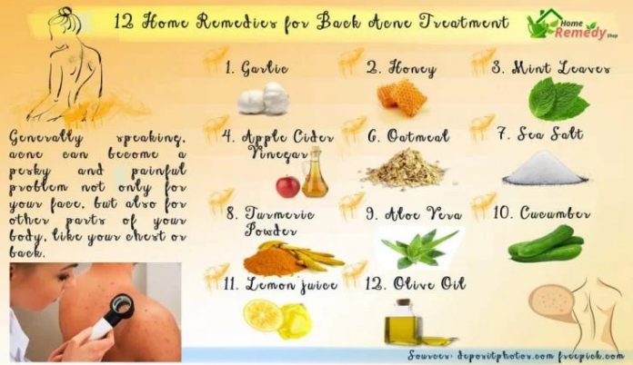 4 Natural Remedies for Acne That Will Clean Your Skin
