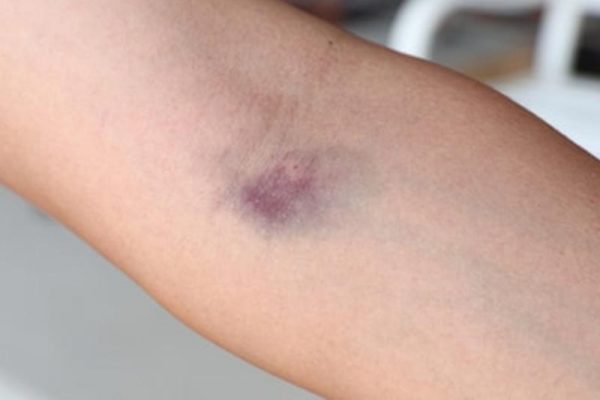 Common Tattoo Side Effects To Check Out